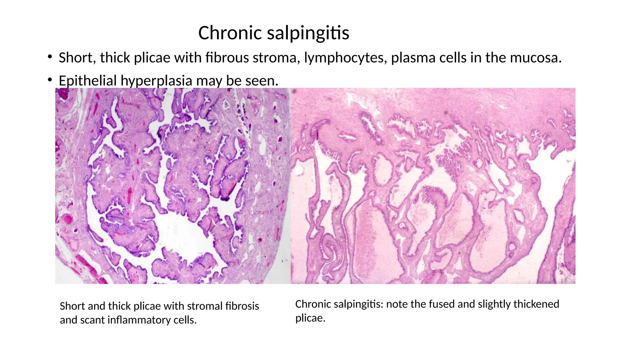 Fallopian tubes pathology (1) (1).pptx by almwork amhar | PPTX