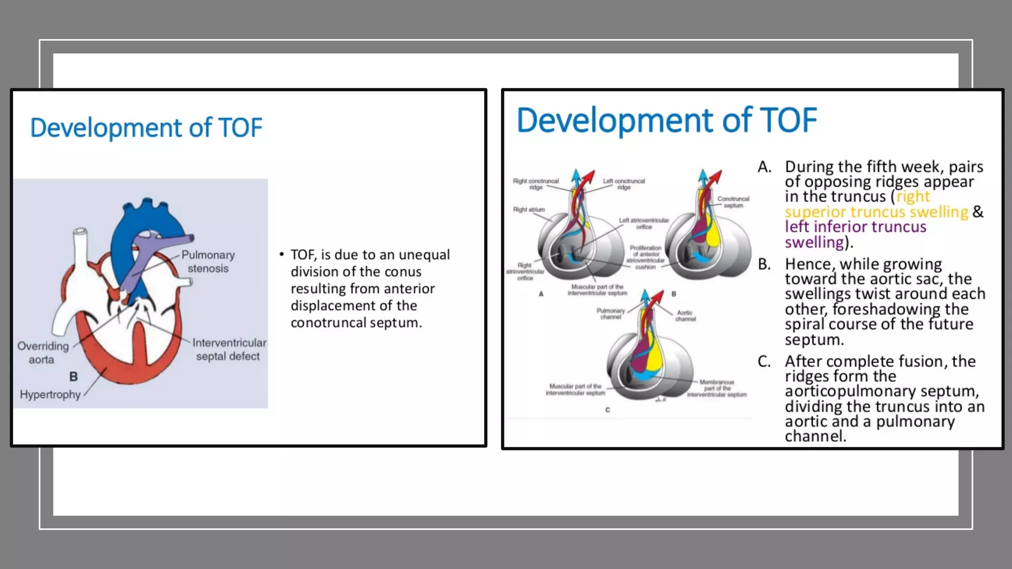 Fallot tetralogy and Ventricular septal defect - EMBRYOLOGY | PPT