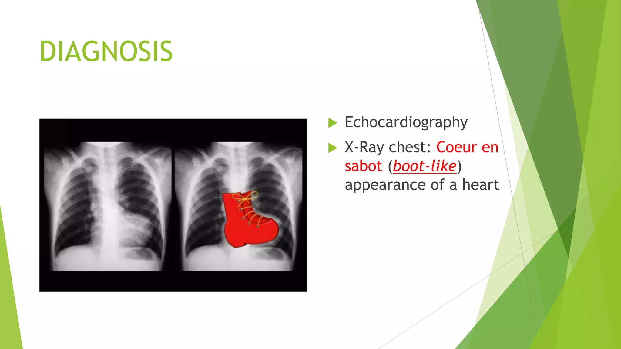 Fallot tetralogy and Ventricular septal defect - EMBRYOLOGY | PPT