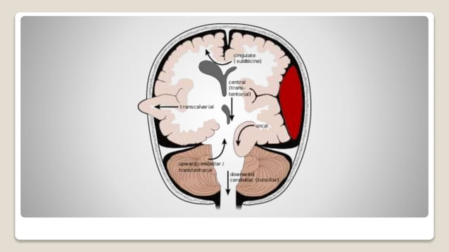 False Localising Signs In Neurology.pptx | Brain and Nervous System ...
