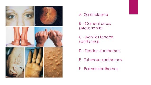 Xanthelasma Vs Xanthoma