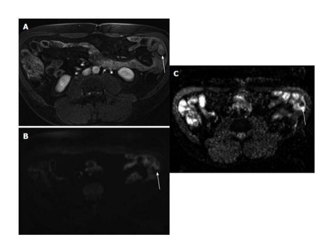 Familial poliposis syndrome imaging