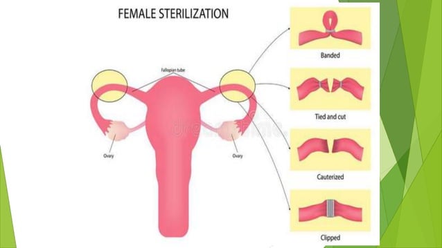 Family Planning (Contraceptive) Methods.pptx