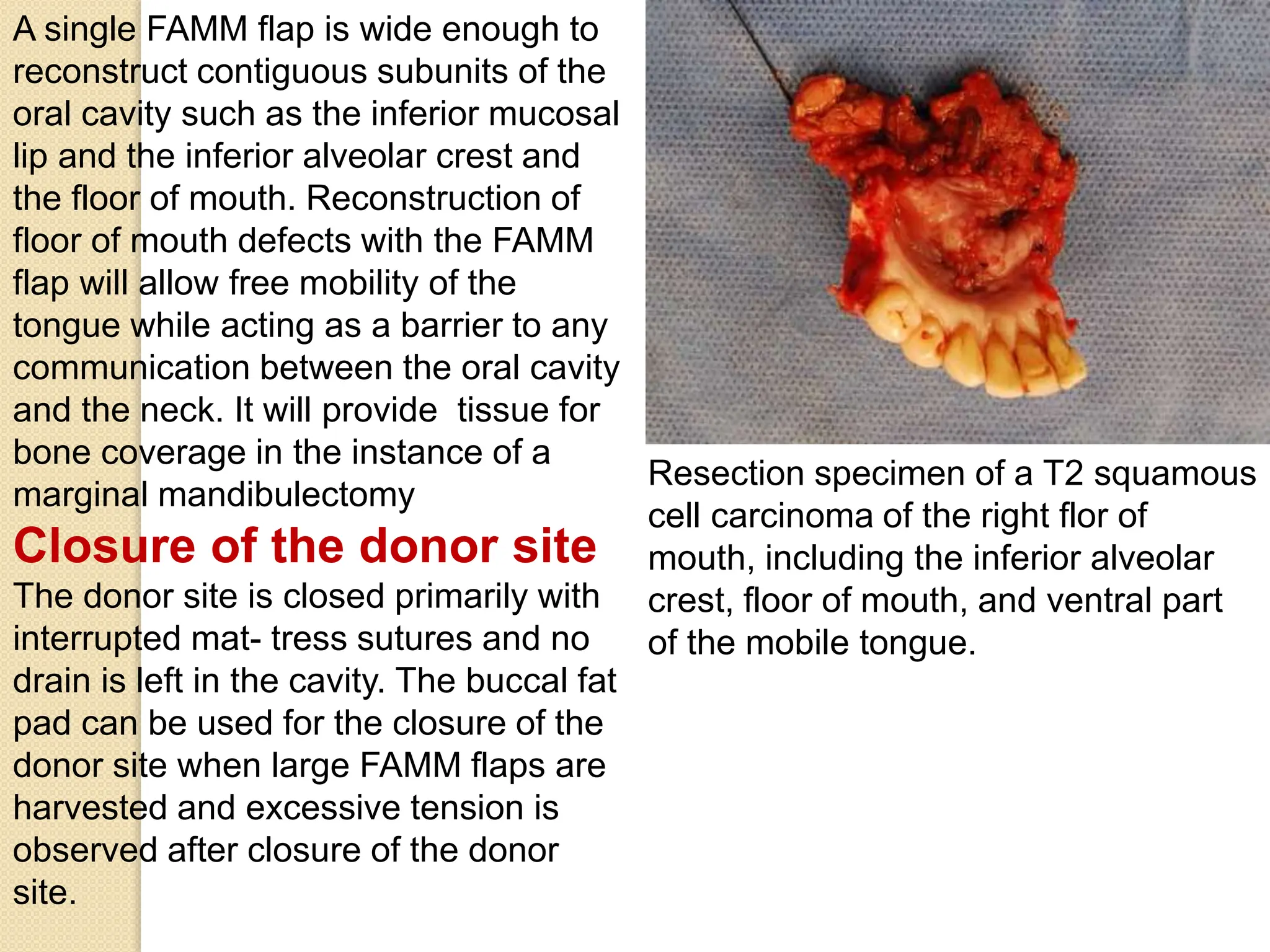 Facial -Artery -musclo -mucosal -Flap presntion | PPTX
