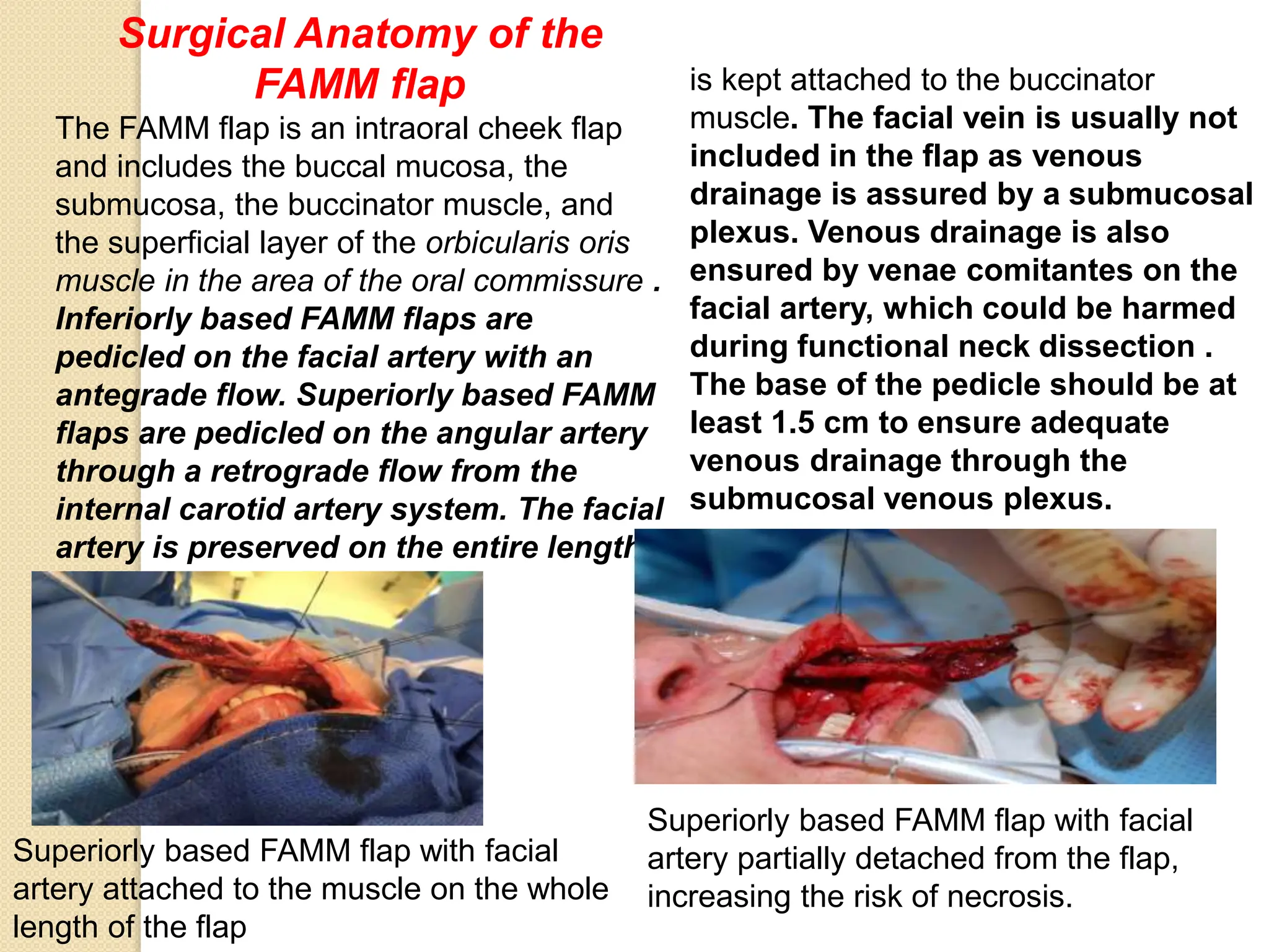 Facial -Artery -musclo -mucosal -Flap presntion | PPTX