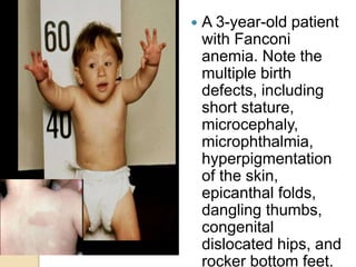 Fanconi’s Anemia | PPT