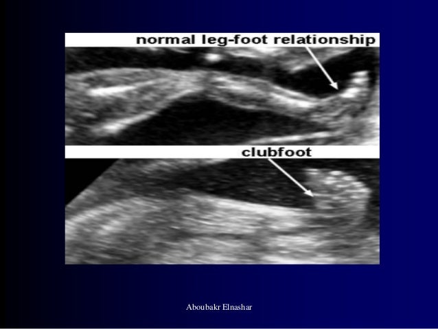 The Anomalies Of Fetus Ultrasound