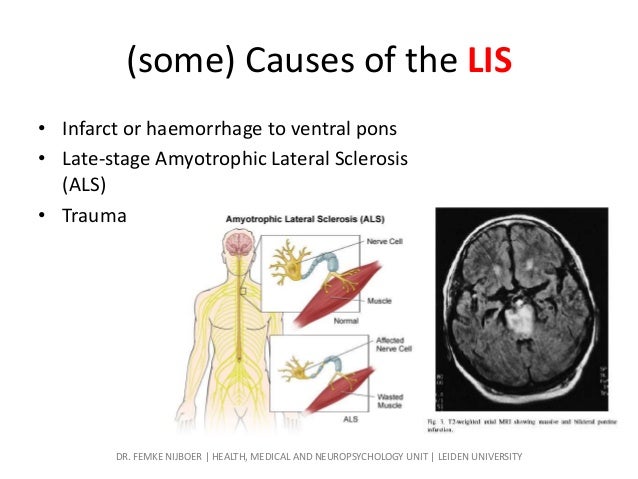 Frequently Asked Questions about the Locked-In Syndrome