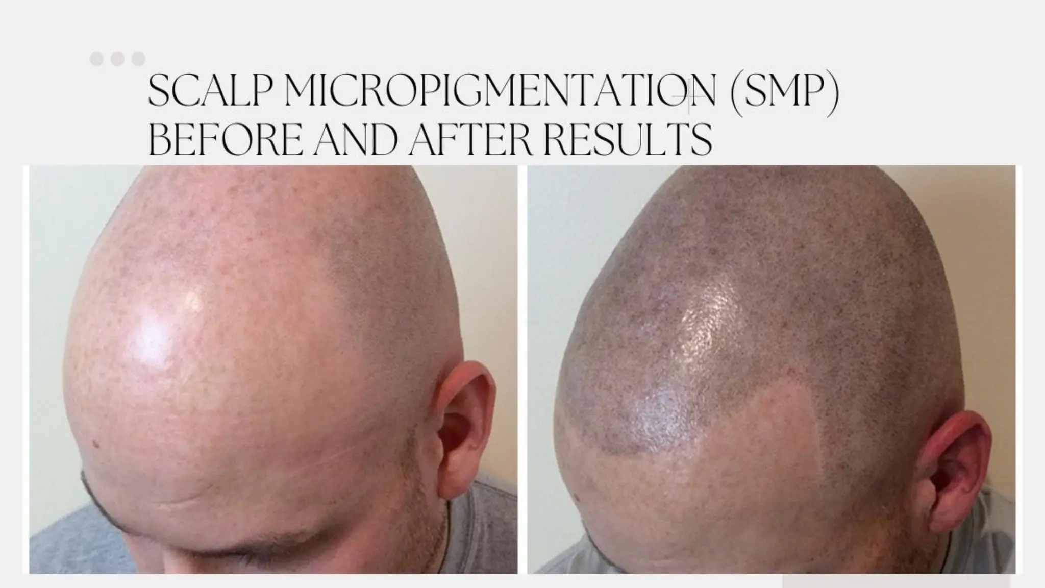 Faqs On Scalp Micropigmentation Hair Tattoo Atlanta Pdf