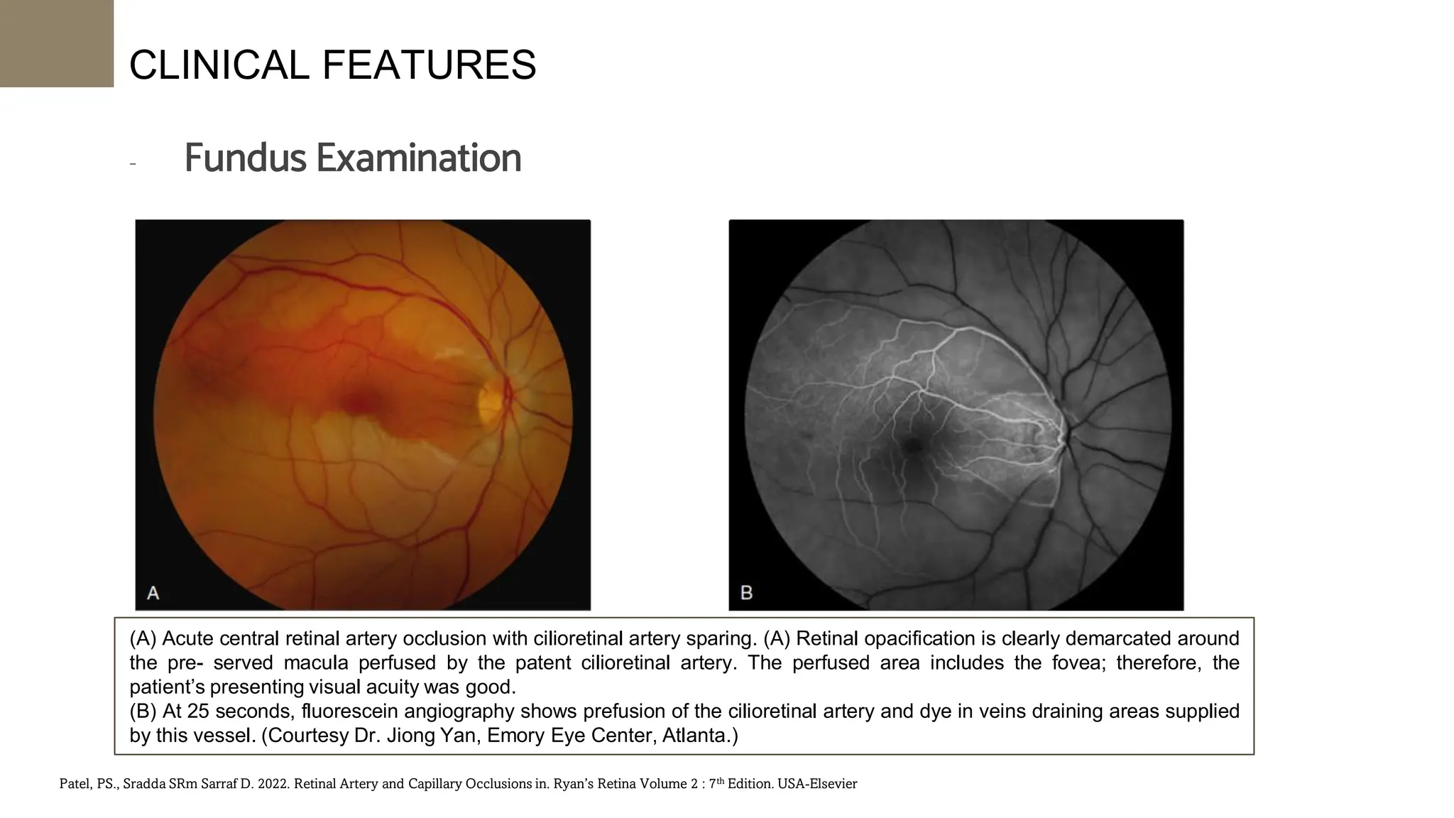 DIAGNOSIS AND MANAGEMENT CENTRAL RETINA L ARTERY OCCLUSION | PDF