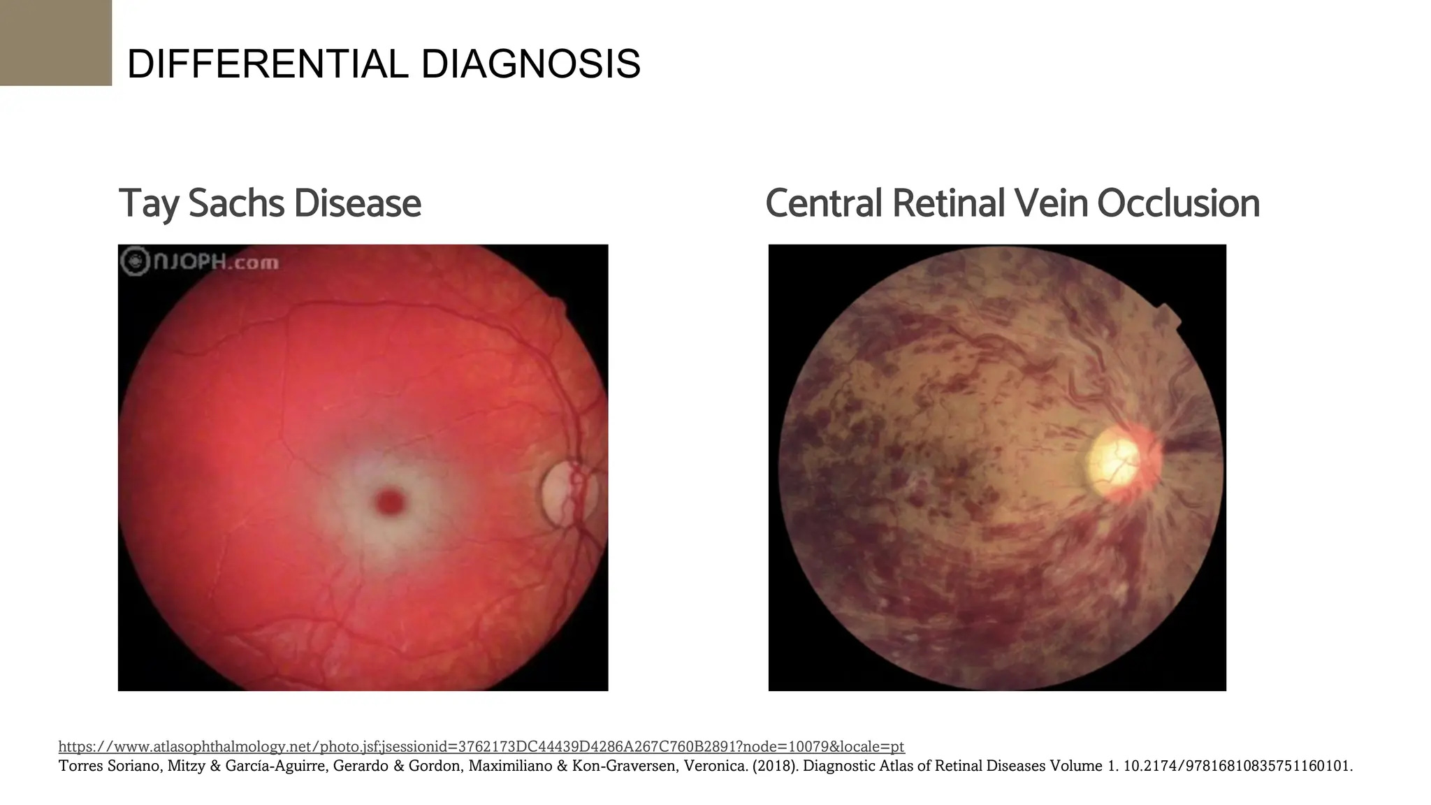 DIAGNOSIS AND MANAGEMENT CENTRAL RETINA L ARTERY OCCLUSION | PDF
