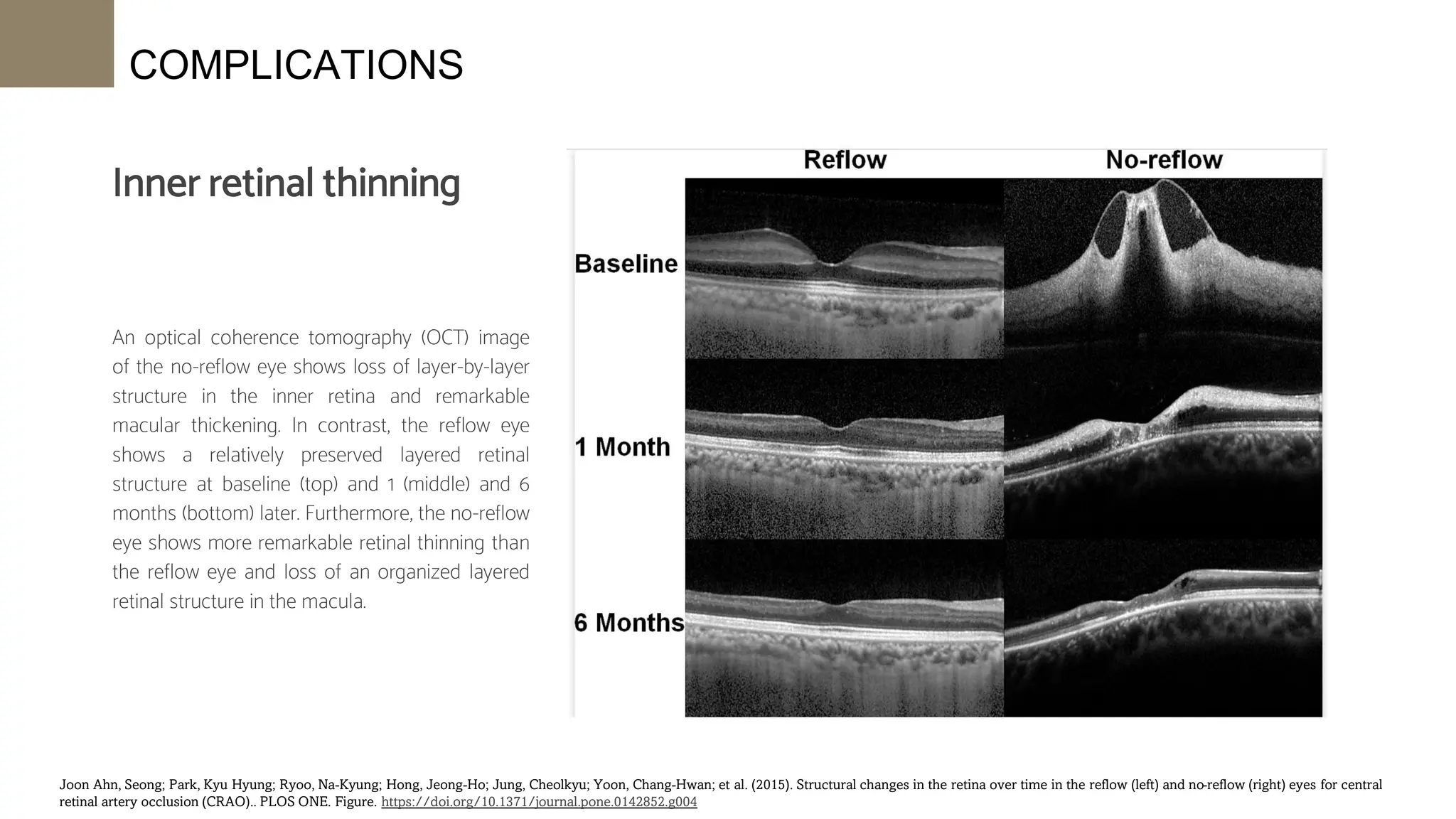 DIAGNOSIS AND MANAGEMENT CENTRAL RETINA L ARTERY OCCLUSION | PDF