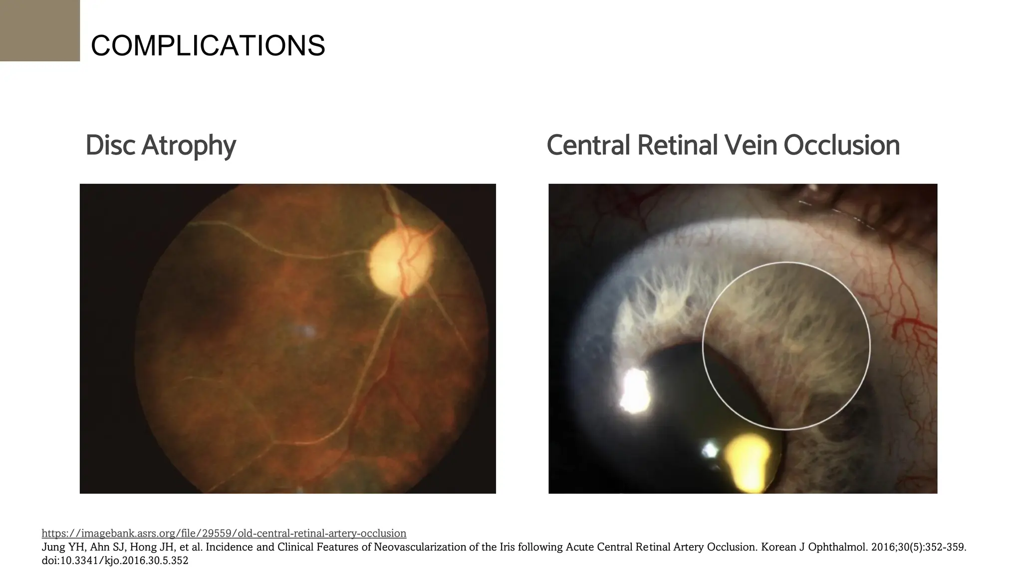 DIAGNOSIS AND MANAGEMENT CENTRAL RETINA L ARTERY OCCLUSION | PDF