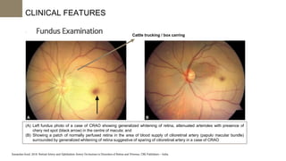 DIAGNOSIS AND MANAGEMENT CENTRAL RETINA L ARTERY OCCLUSION | PDF
