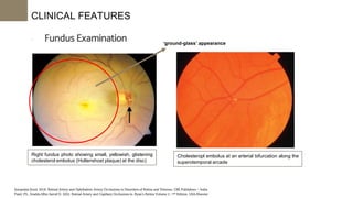 DIAGNOSIS AND MANAGEMENT CENTRAL RETINA L ARTERY OCCLUSION | PDF