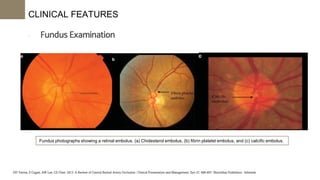 DIAGNOSIS AND MANAGEMENT CENTRAL RETINA L ARTERY OCCLUSION | PDF