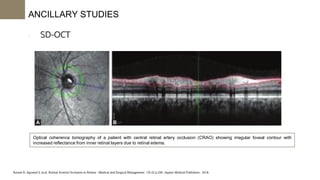 DIAGNOSIS AND MANAGEMENT CENTRAL RETINA L ARTERY OCCLUSION | PDF