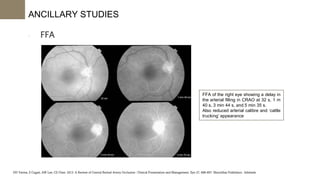 DIAGNOSIS AND MANAGEMENT CENTRAL RETINA L ARTERY OCCLUSION | PDF
