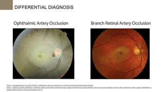 DIAGNOSIS AND MANAGEMENT CENTRAL RETINA L ARTERY OCCLUSION | PDF