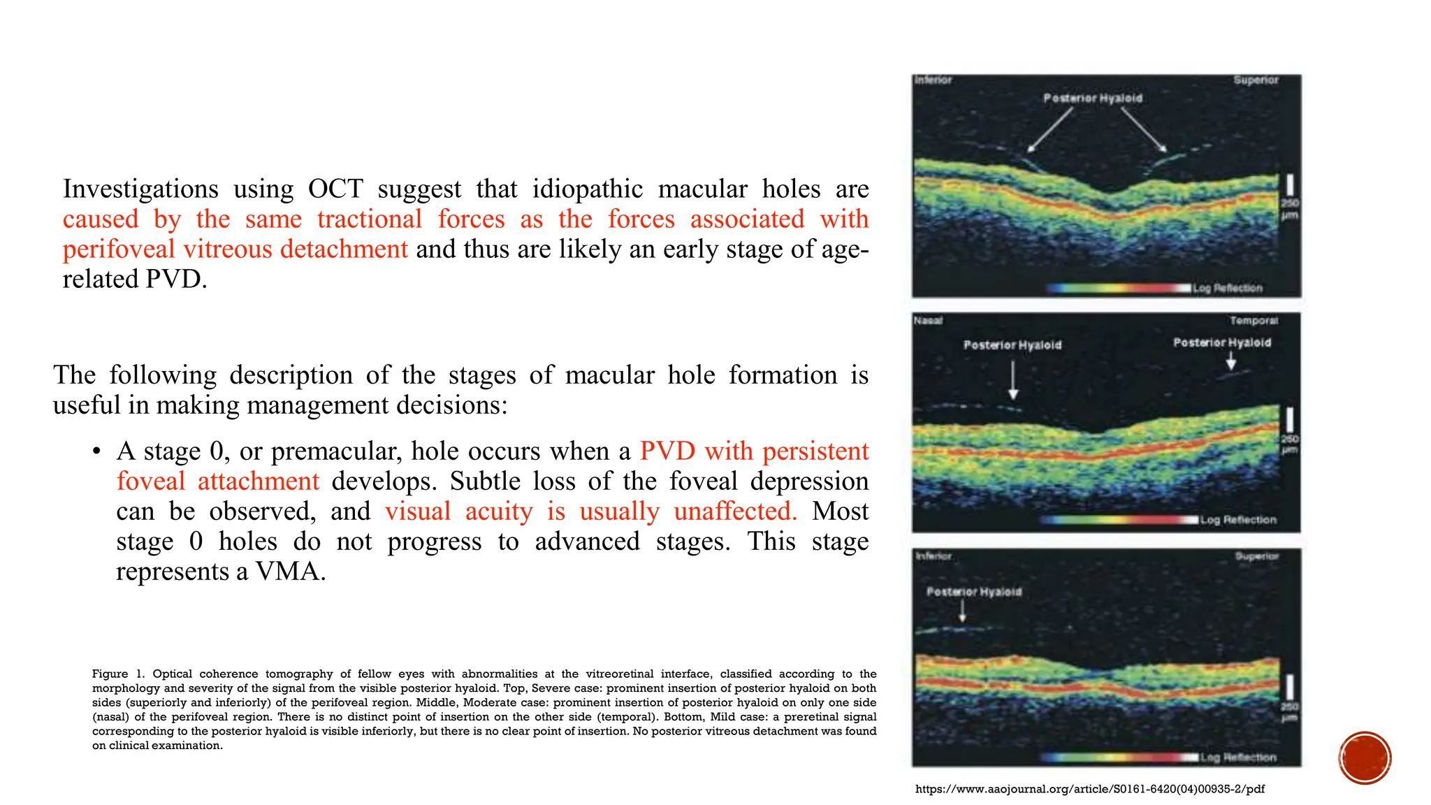 DISEASE OF THE VITREOUS AND VITREORETINAL INTERFACE.pptx