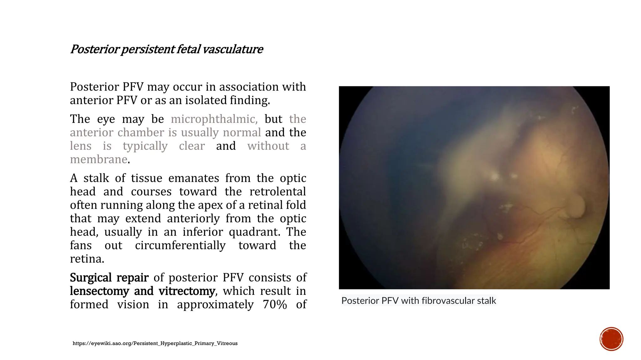 DISEASE OF THE VITREOUS AND VITREORETINAL INTERFACE.pptx