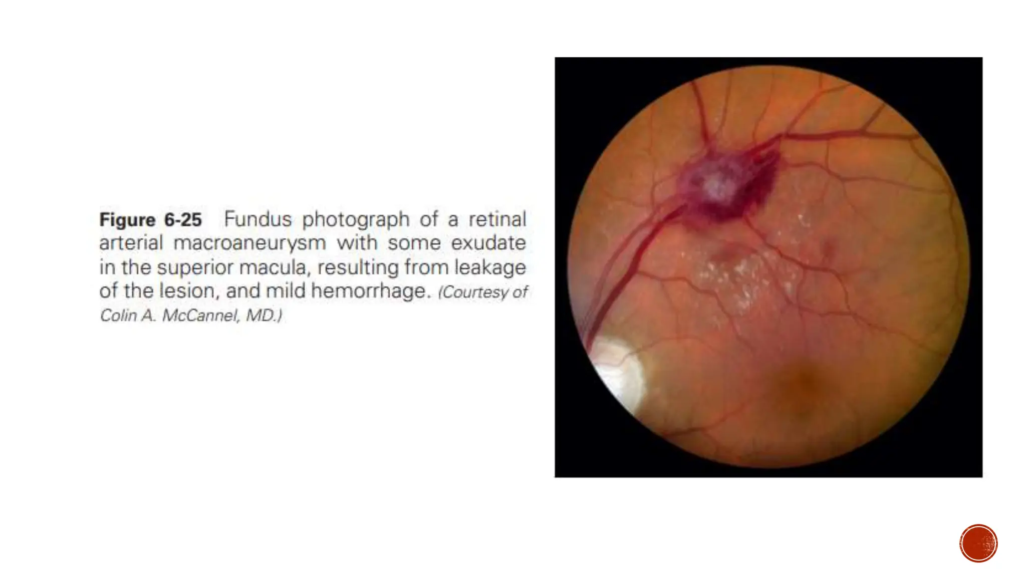 FAR - OIS RAO retinal aretery occlusion AAO | PPT