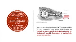 FAR - OIS RAO retinal aretery occlusion AAO | PPT