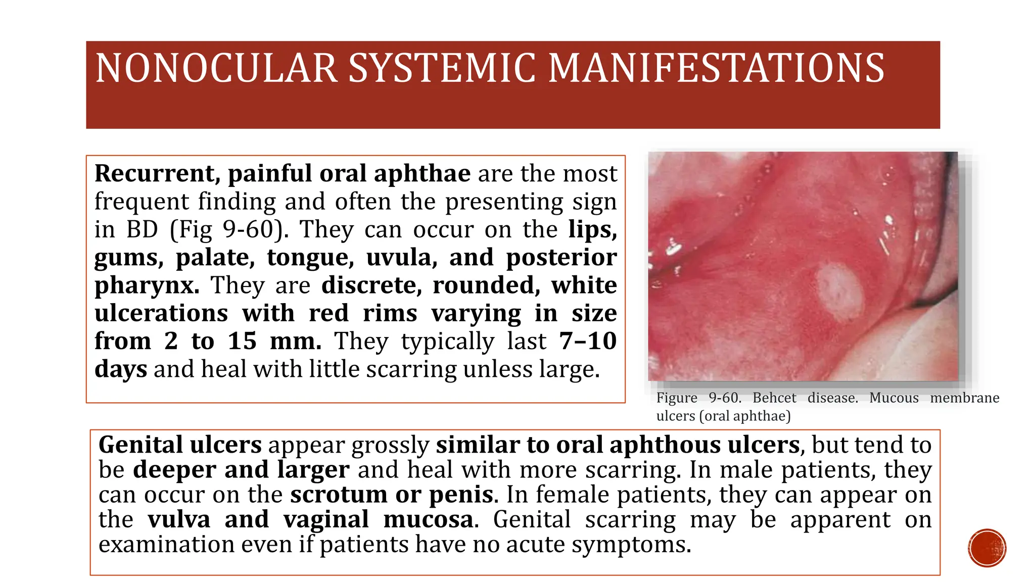 Panuveitis BEHCET DISEASE AAO Reading.pptx