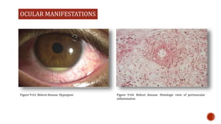 Panuveitis BEHCET DISEASE AAO Reading.pptx