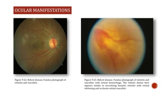 Panuveitis BEHCET DISEASE AAO Reading.pptx