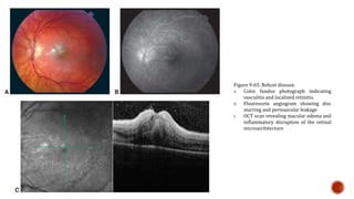 Panuveitis BEHCET DISEASE AAO Reading.pptx