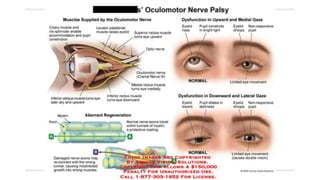 parese n.iii oculomotorius in ophthalmology | PPTX