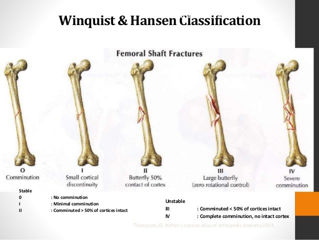 Closed Fractur 1/3 Middle Femur Sinistra