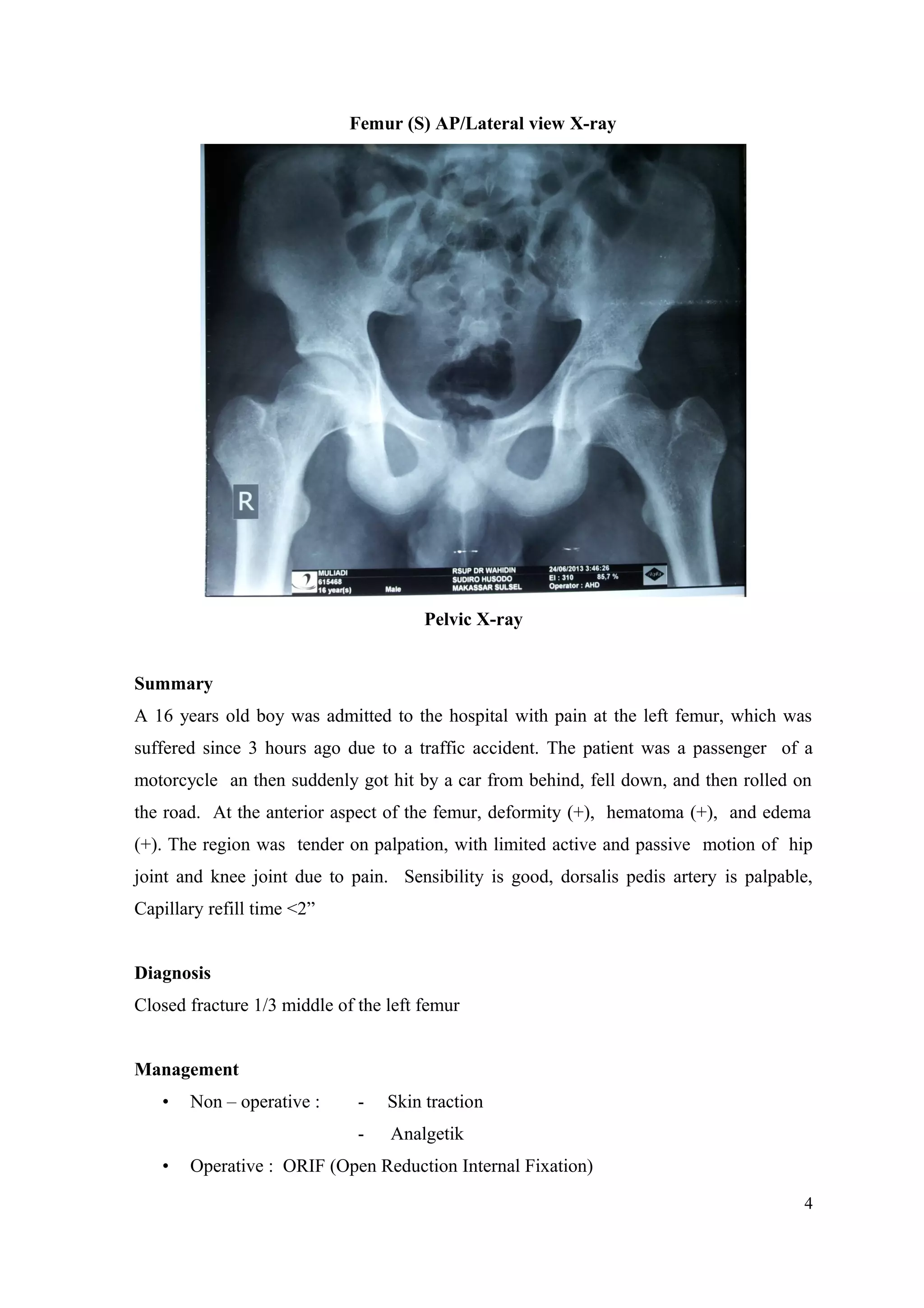 Case Report : closed fracture 1/3 middle left femur | DOC