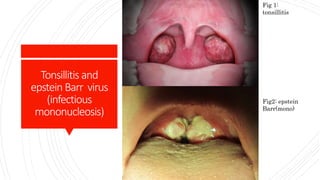 Fareedah Muheeb differential diagnosis of Tonsillitis.pptx