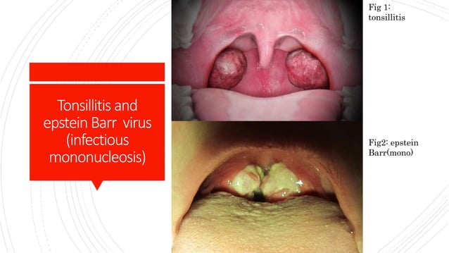 Fareedah Muheeb differential diagnosis of Tonsillitis.pptx
