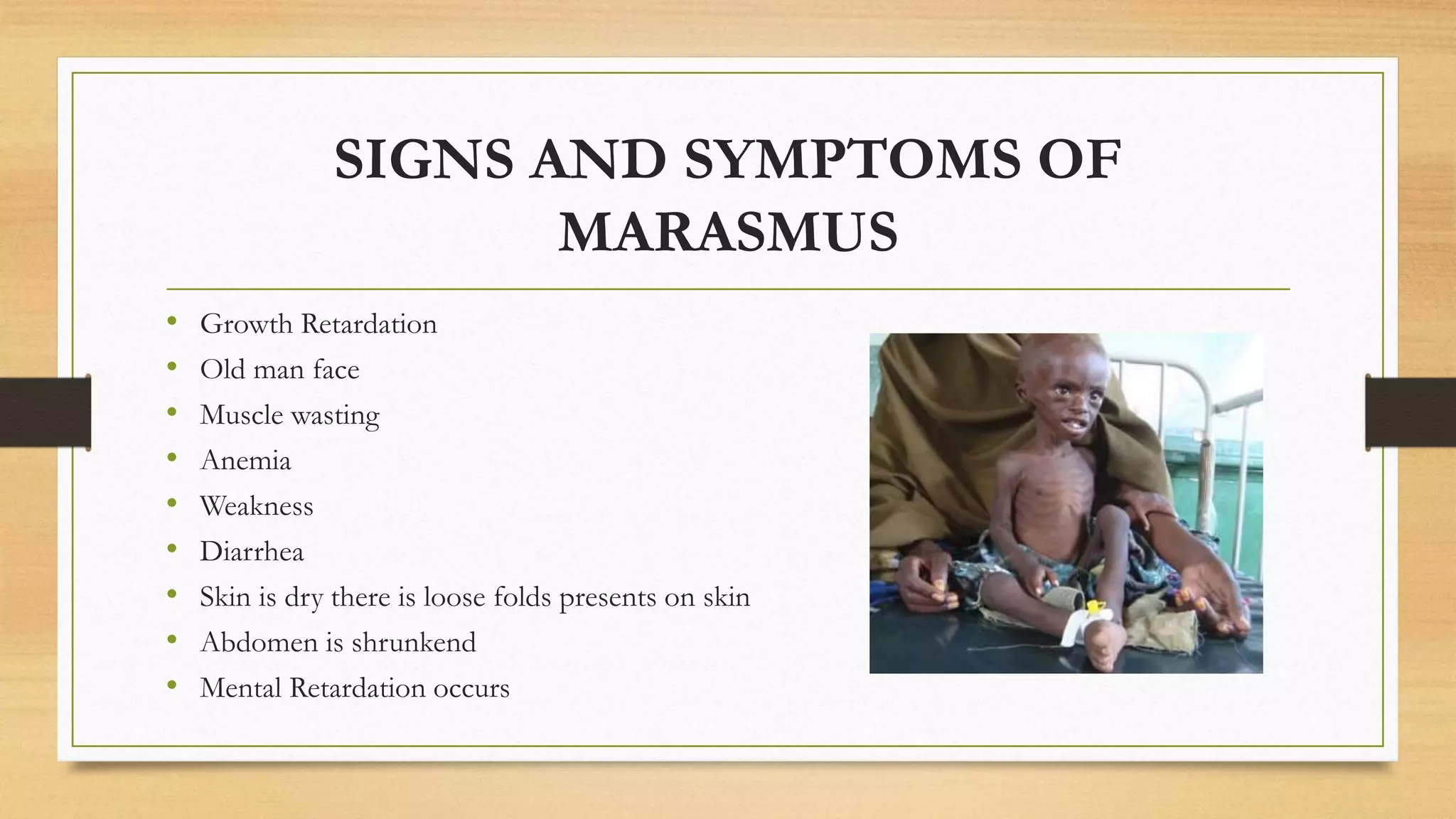 PEM protein Energy Malnutrition | PPTX