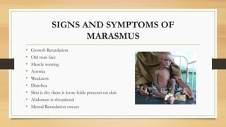 PEM protein Energy Malnutrition | PPTX