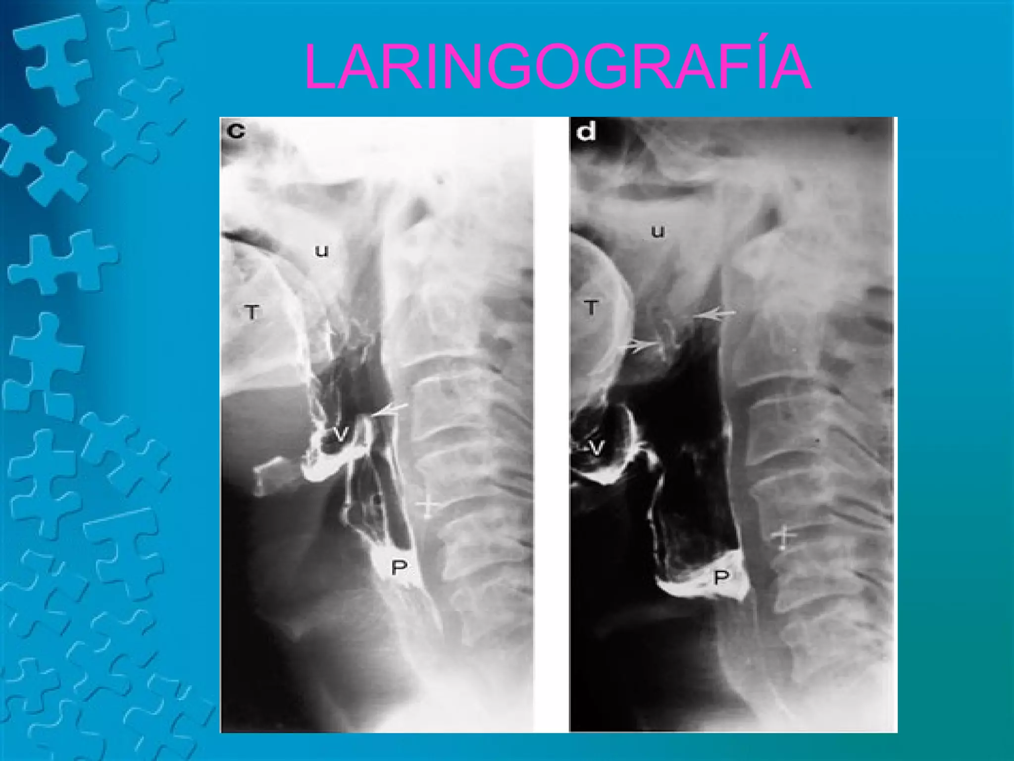 Anatomía Radiológica de Faringe y Laringe | PPT