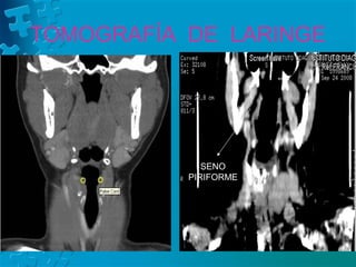 Anatomía Radiológica de Faringe y Laringe | PPT