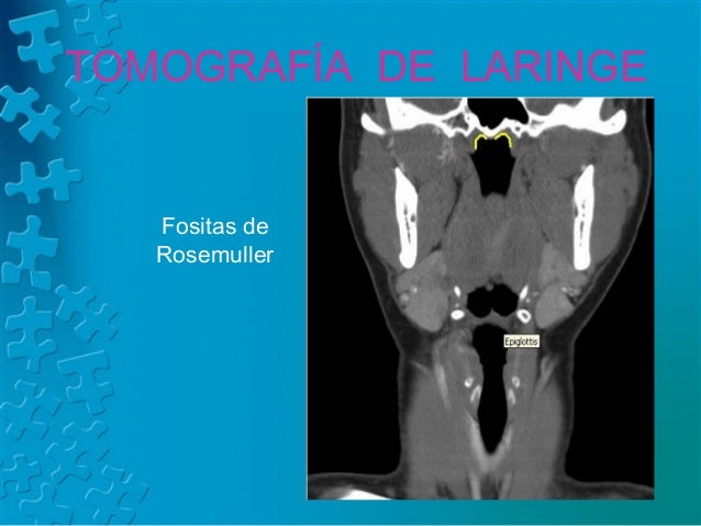 Anatomía Radiológica de Faringe y Laringe