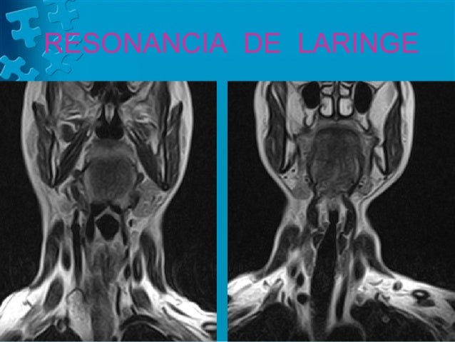 Anatomía Radiológica de Faringe y Laringe