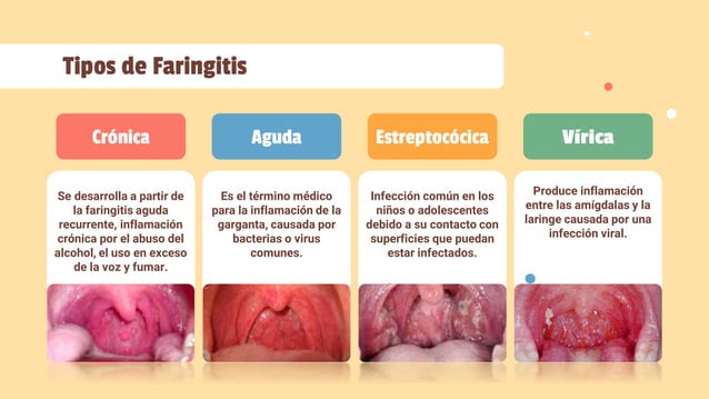 Faringitis