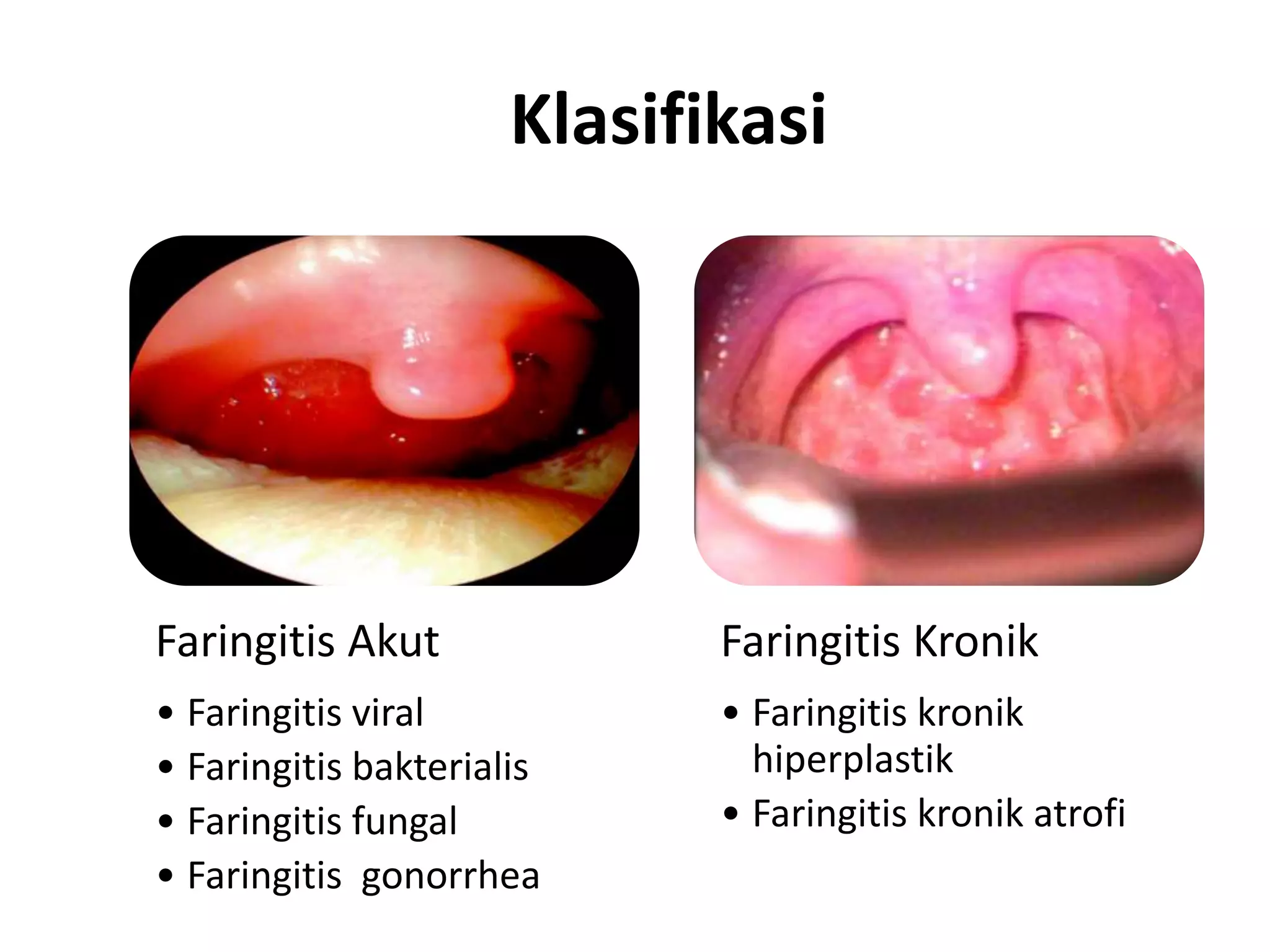 faringitis-ku.ppt