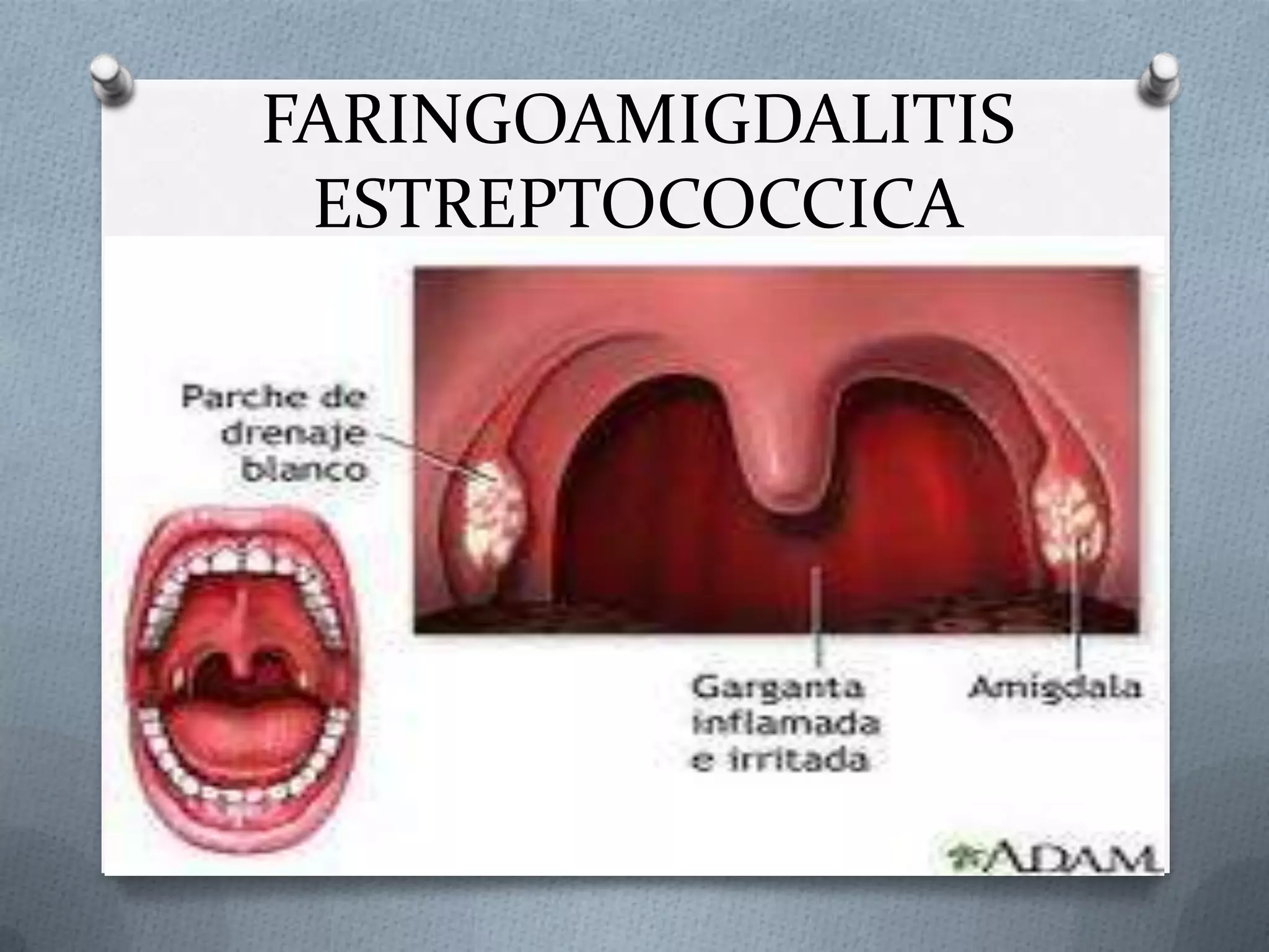 Faringitis oma sinusitis | PPT
