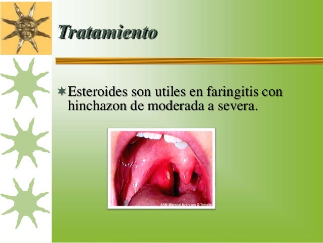 Faringitis aguda y crónica