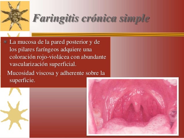 Faringitis aguda y crónica