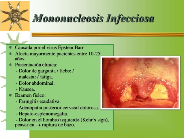 Faringitis aguda y crónica
