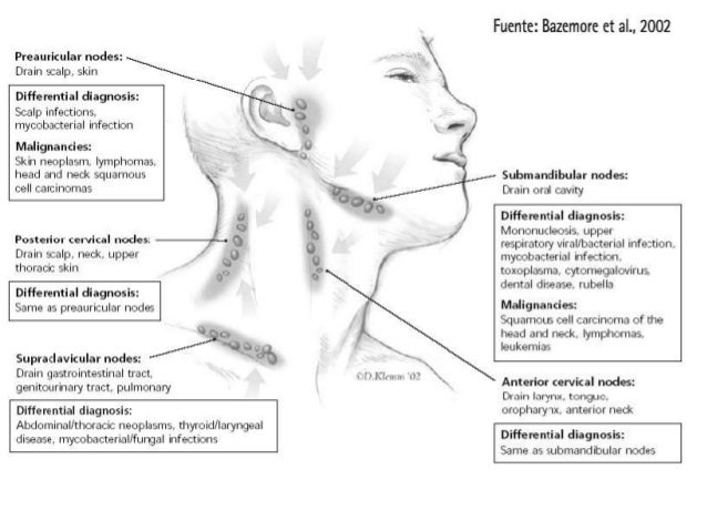 Faringitis amigdalitis