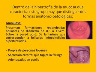 Faringitis Crónica | PPTX
